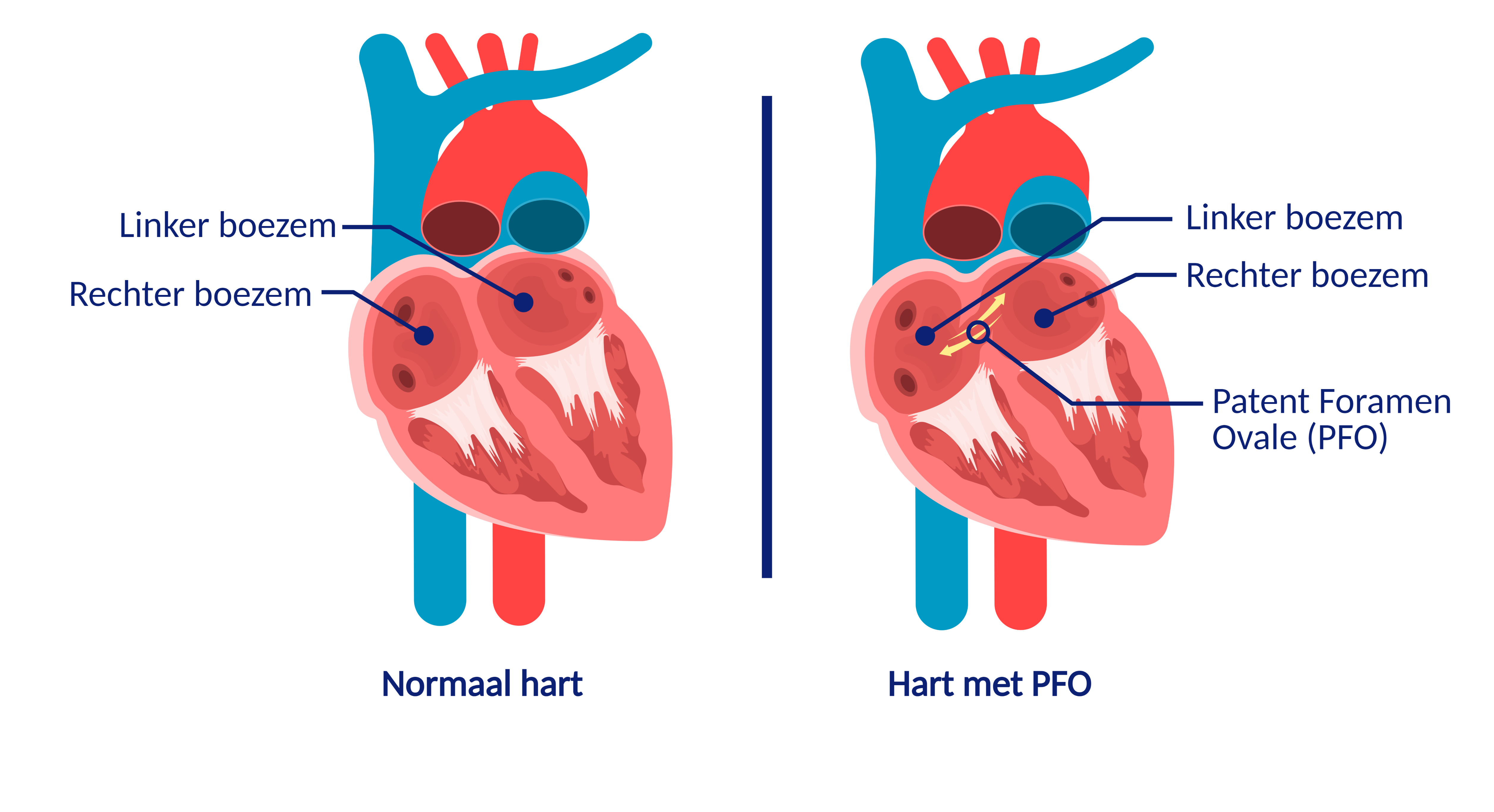 Percutane sluiting van een patent foramen ovale (PFO) - Patiëntenfolder - Erasmus MC