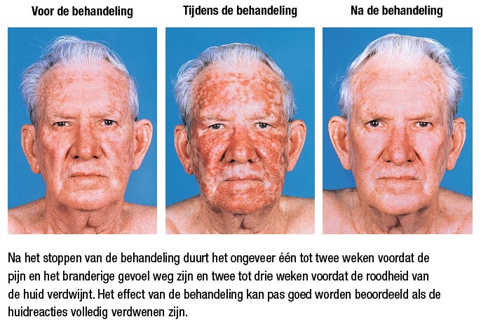 Behandeling met Efudix crème - Patiëntenfolder - Erasmus MC