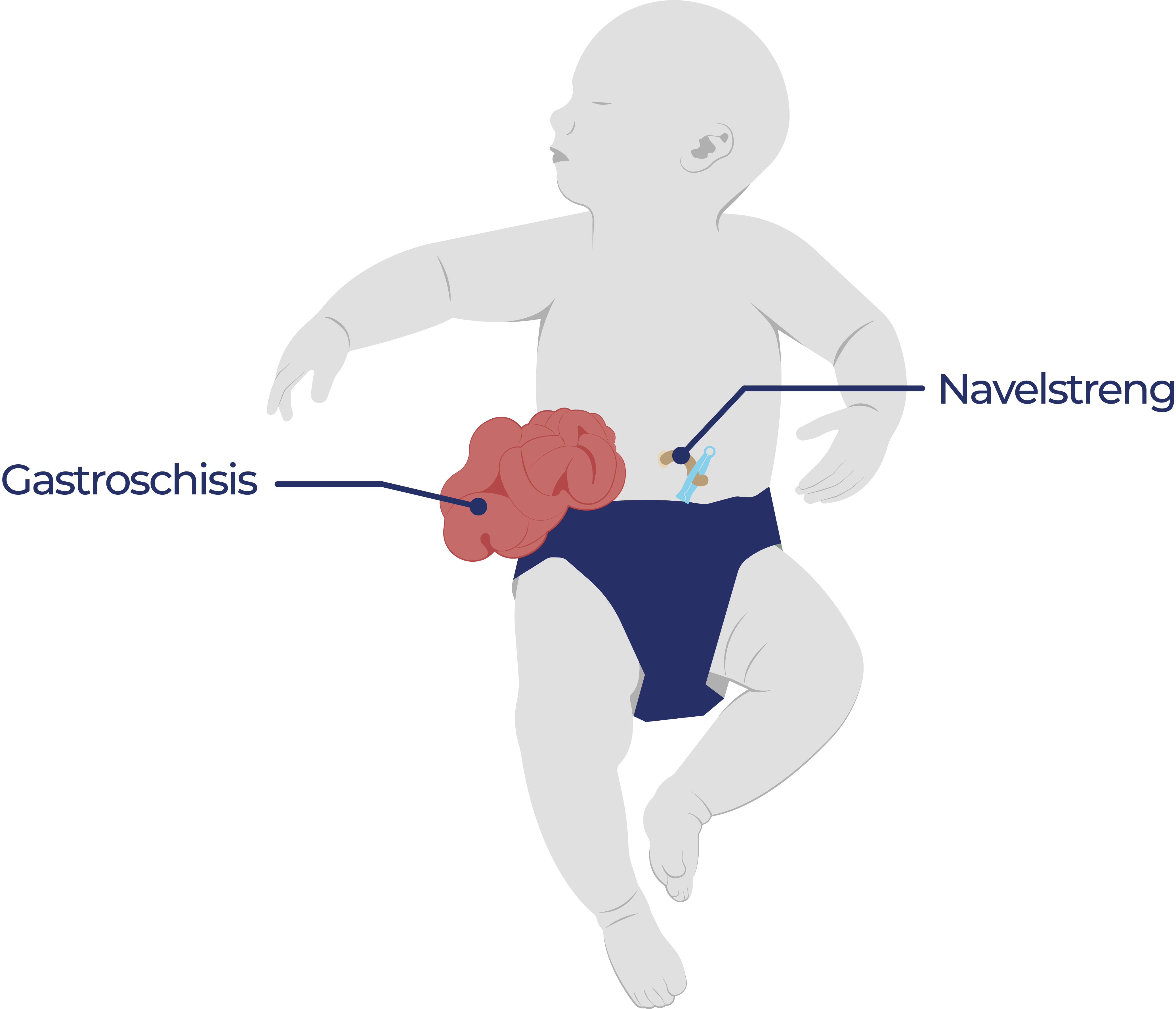 Gastroschisis - Patiëntenfolder - Erasmus MC