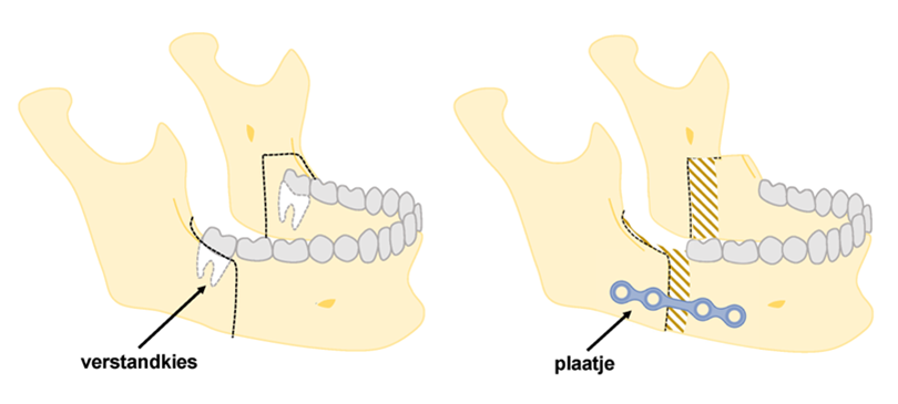 Kaakcorrectie - Patiëntenfolder - Erasmus MC