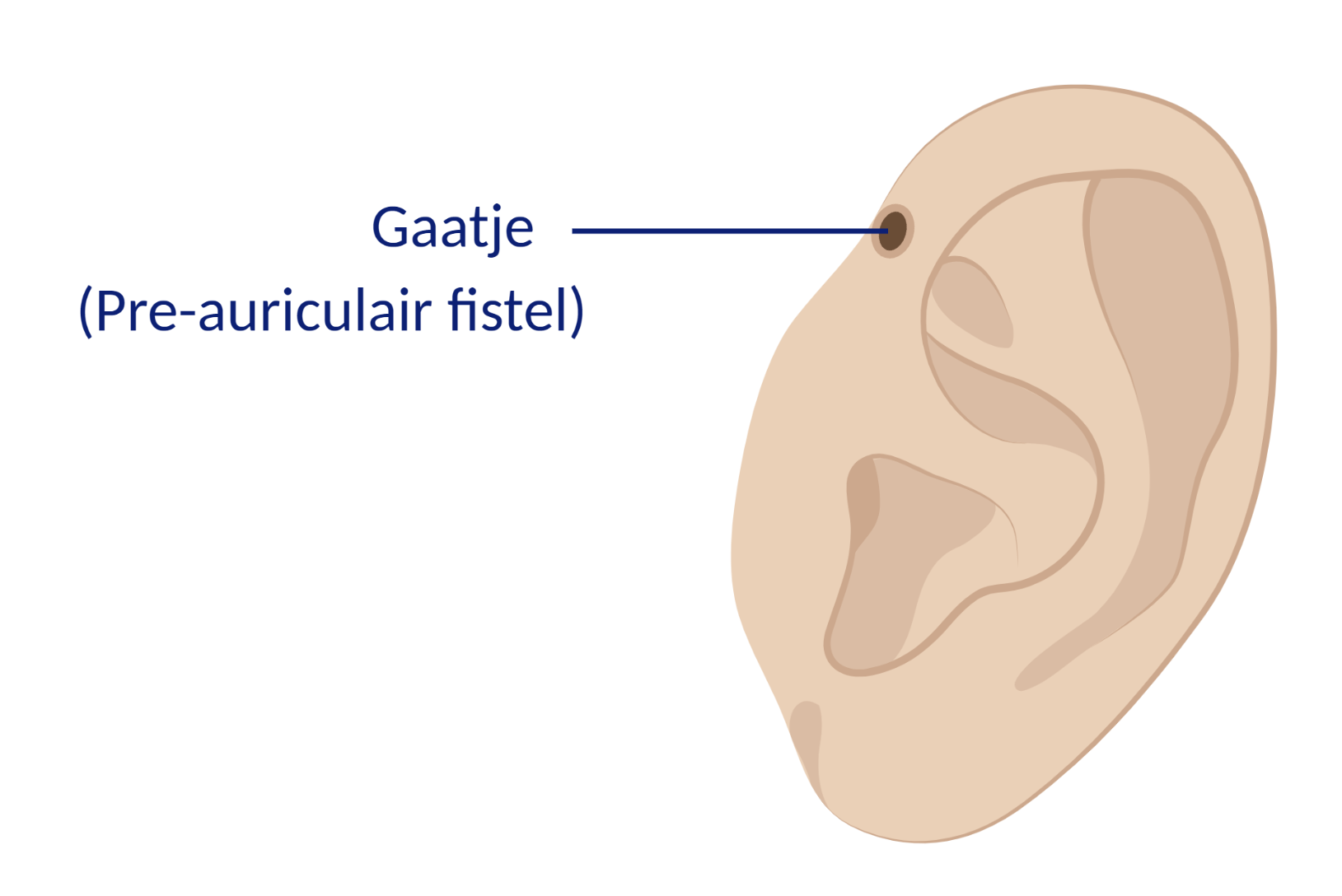 Verwijderen pre-auriculair fistel - Patiëntenfolder - Erasmus MC