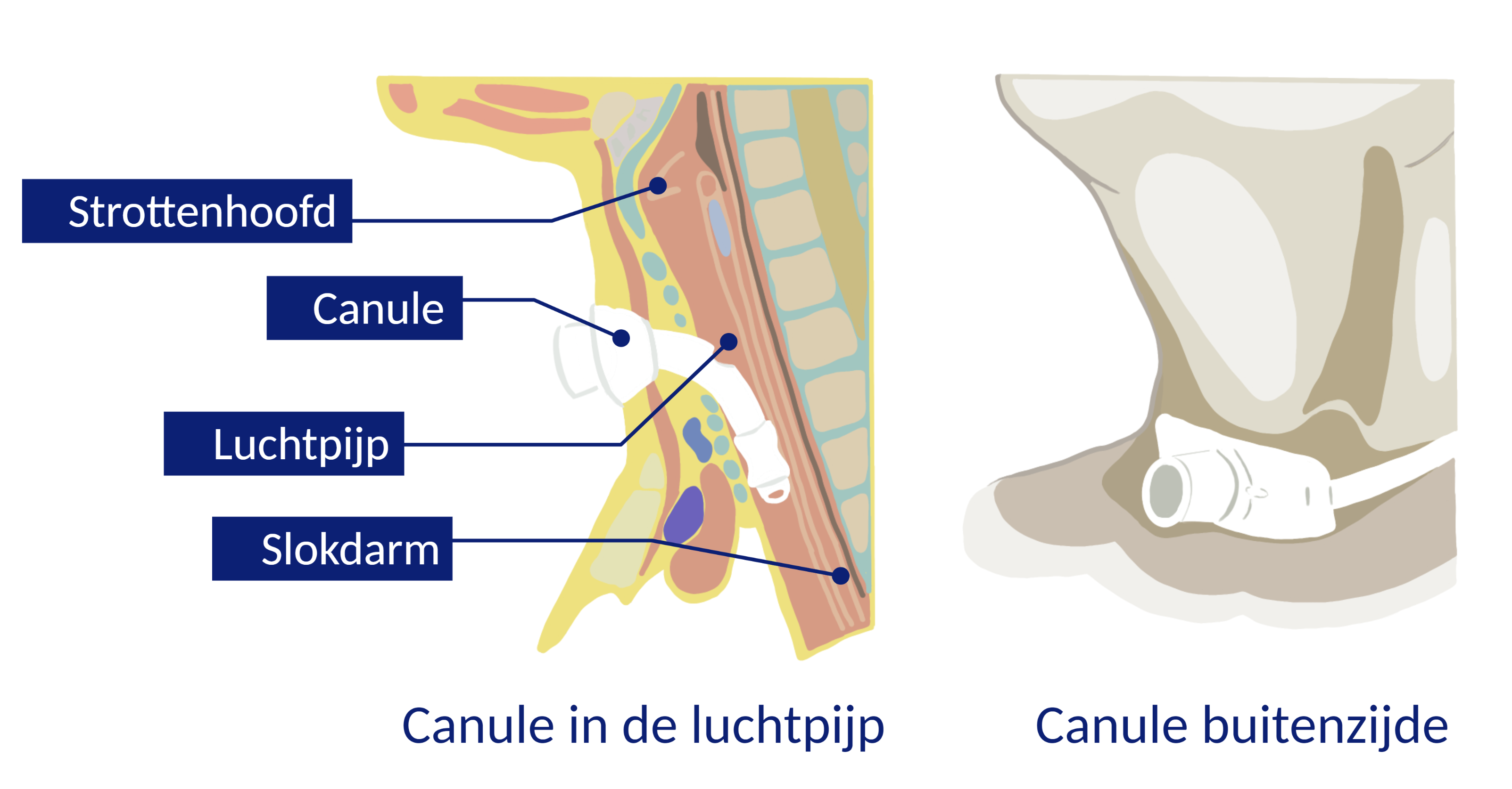 Tracheotomie - Patiëntenfolder - Erasmus MC