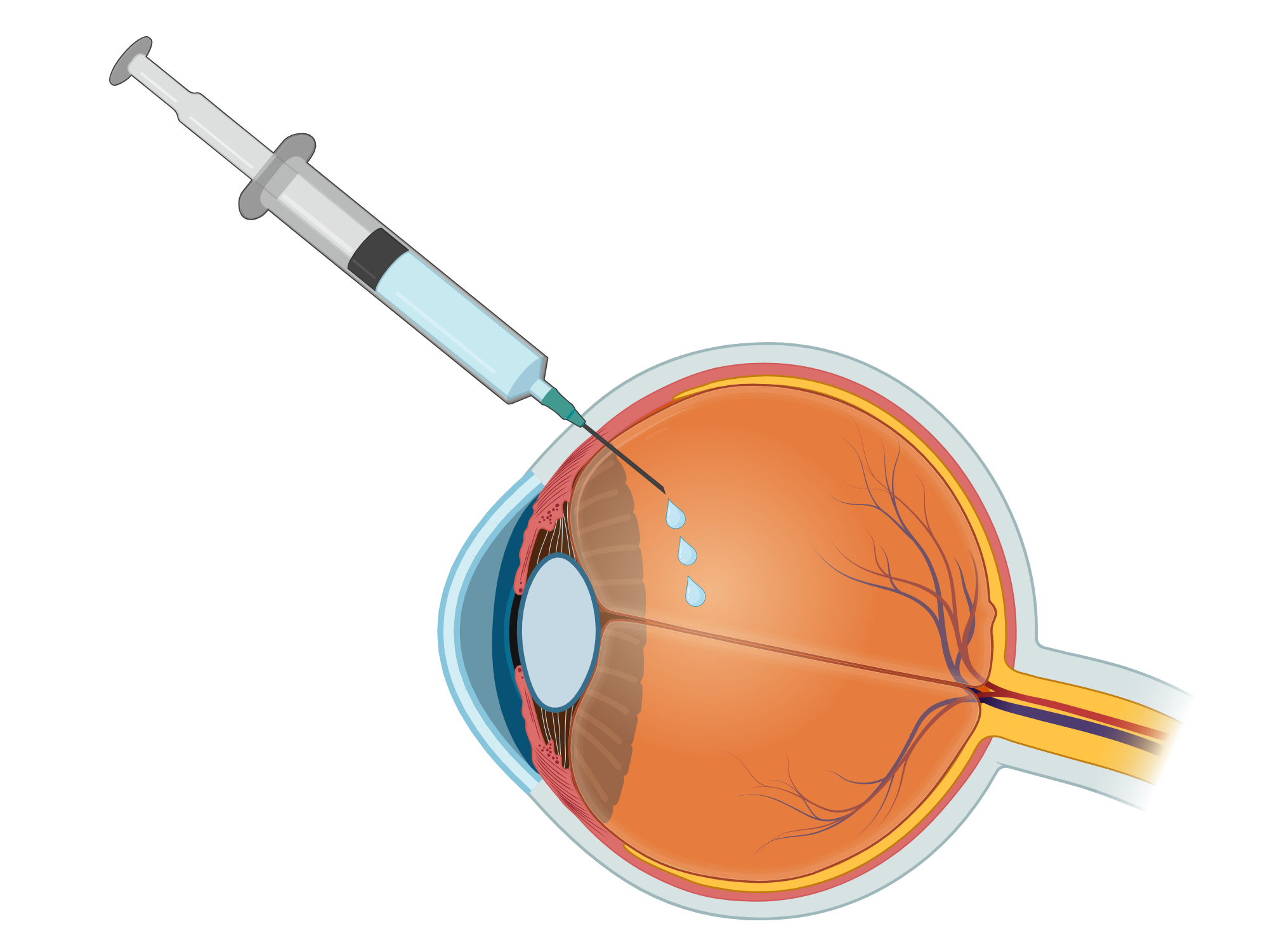Intravitreale injectie - Patiëntenfolder - Erasmus MC