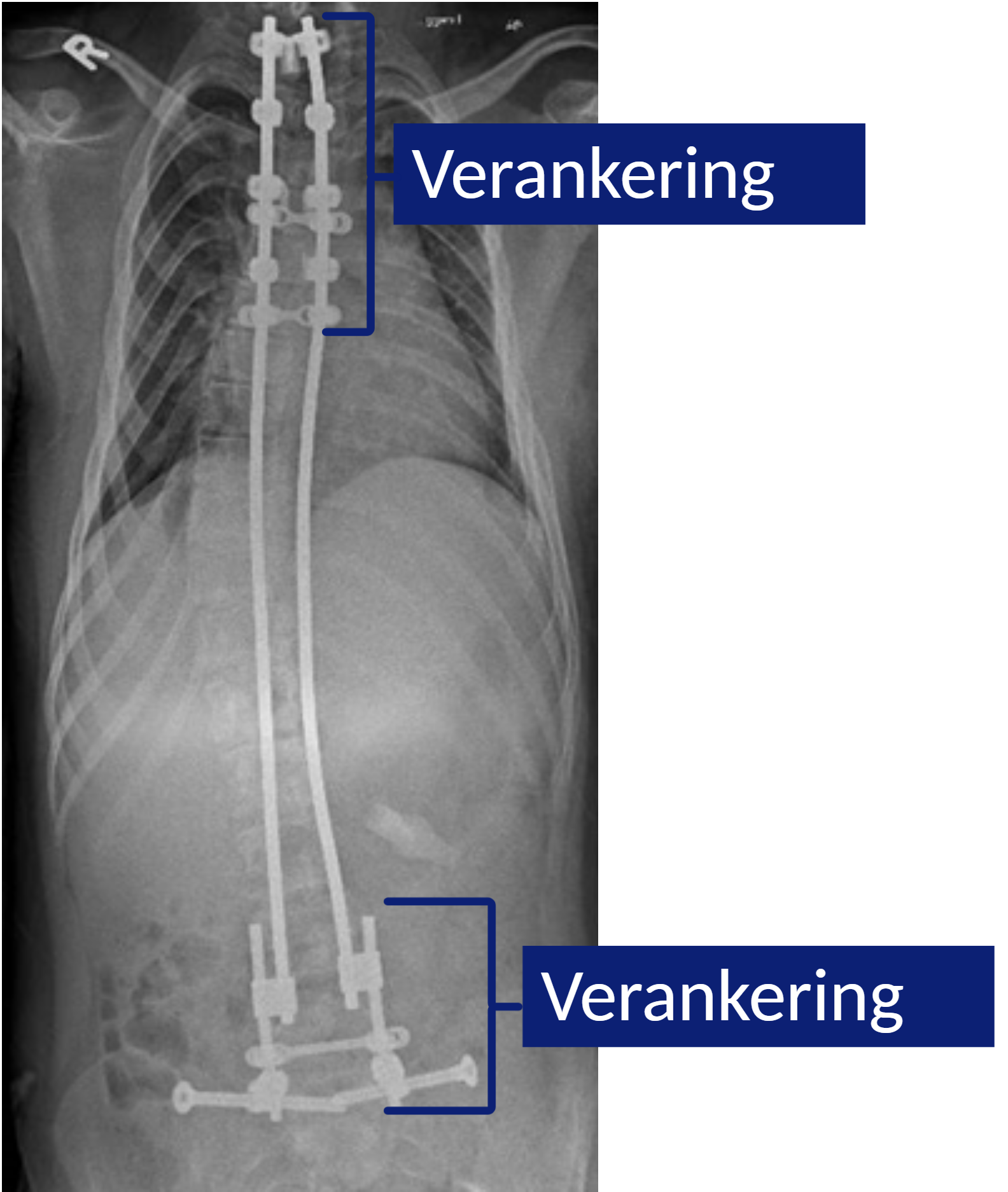 Scoliose - Patiëntenfolder - Erasmus MC