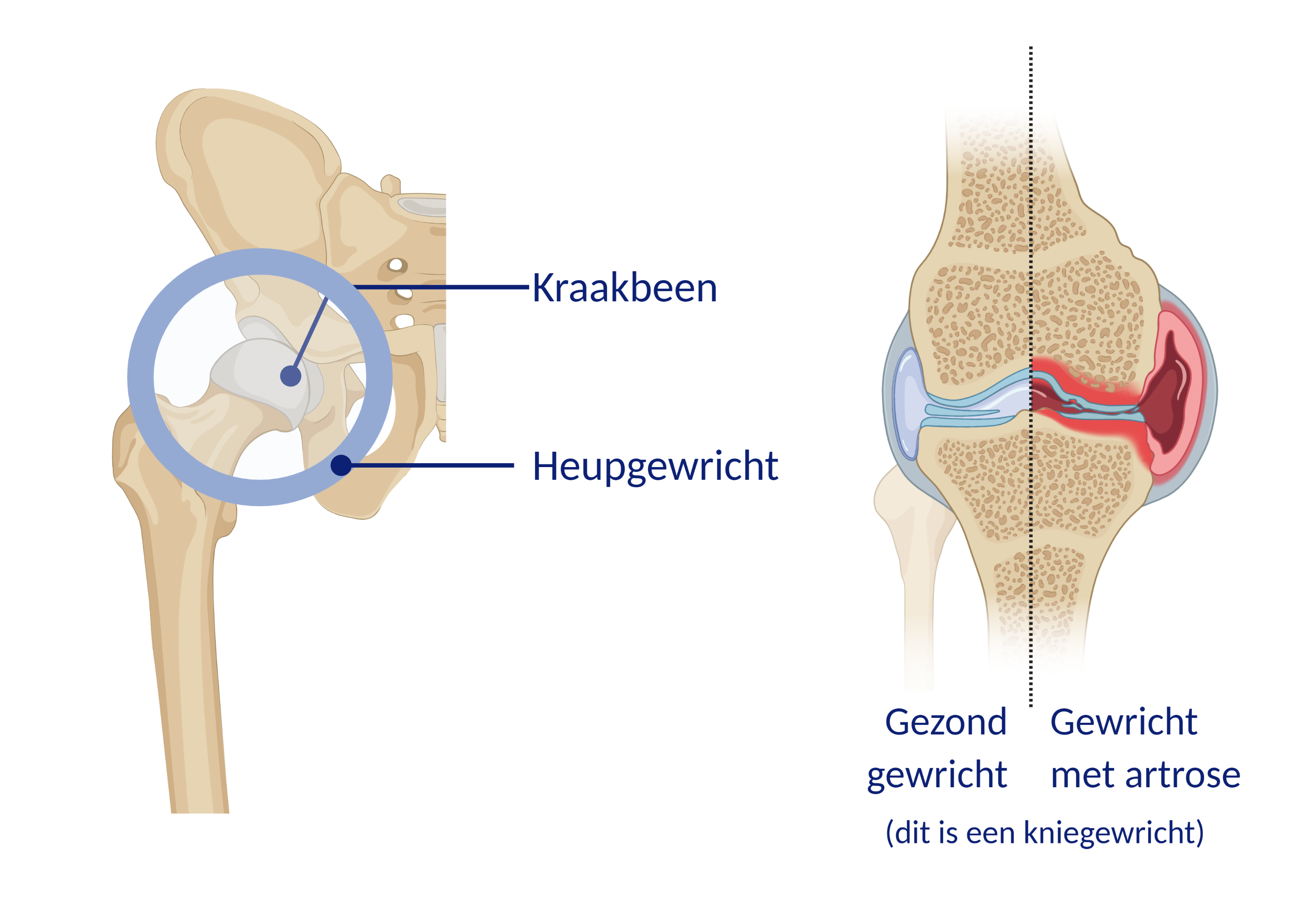 Totale heupprothese - Patiëntenfolder - Erasmus MC