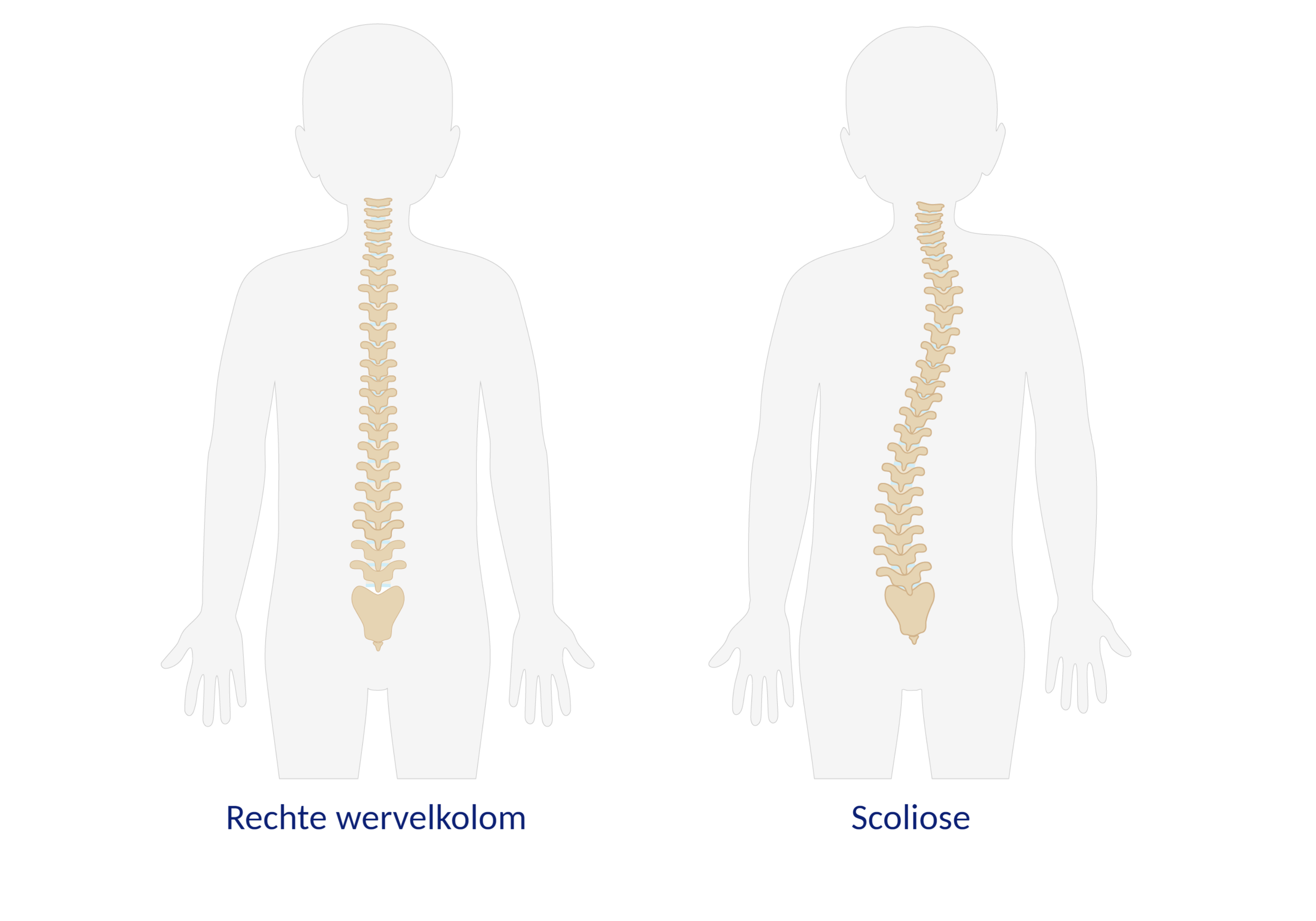 Neuromusculaire scoliose - Patiëntenfolder - Erasmus MC