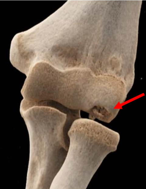 Osteochondritis dissecans (OCD) aan de elleboog - Patiëntenfolder ...