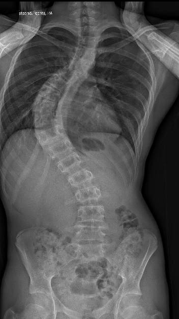 Scoliose - Patiëntenfolder - Erasmus MC