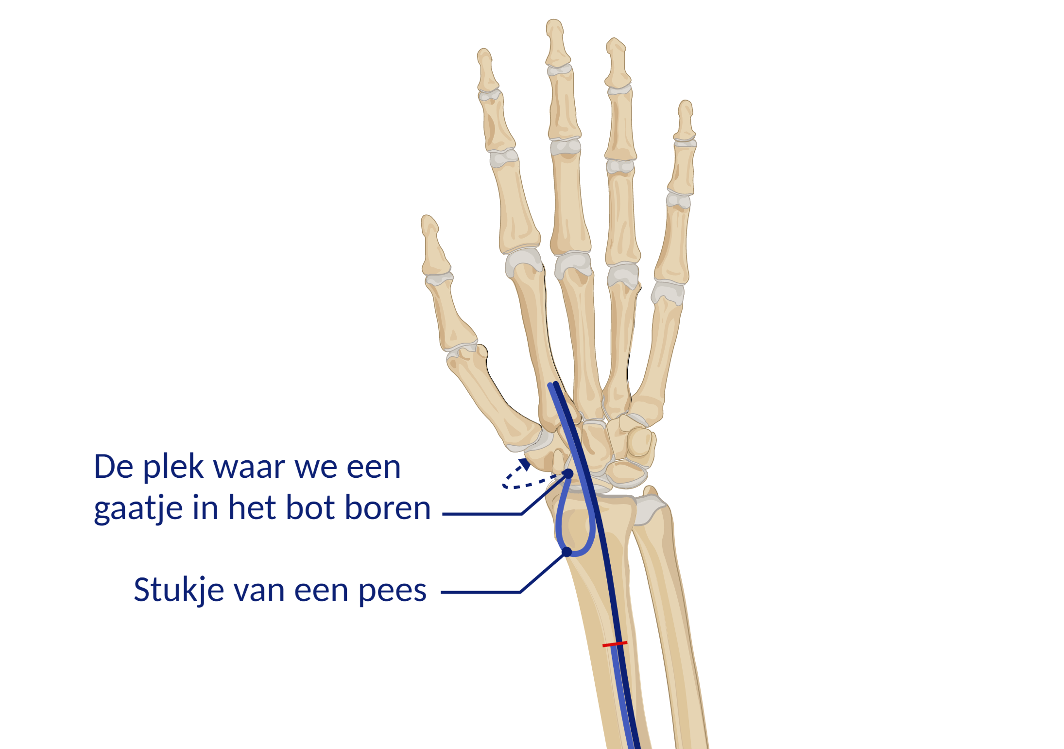 Brunelli plastiek - Patiëntenfolder - Erasmus MC