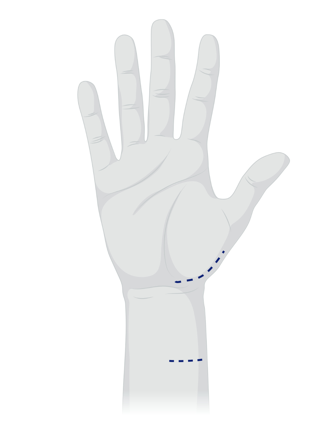 Verwijderen trapeziumbot - Patiëntenfolder - Erasmus MC