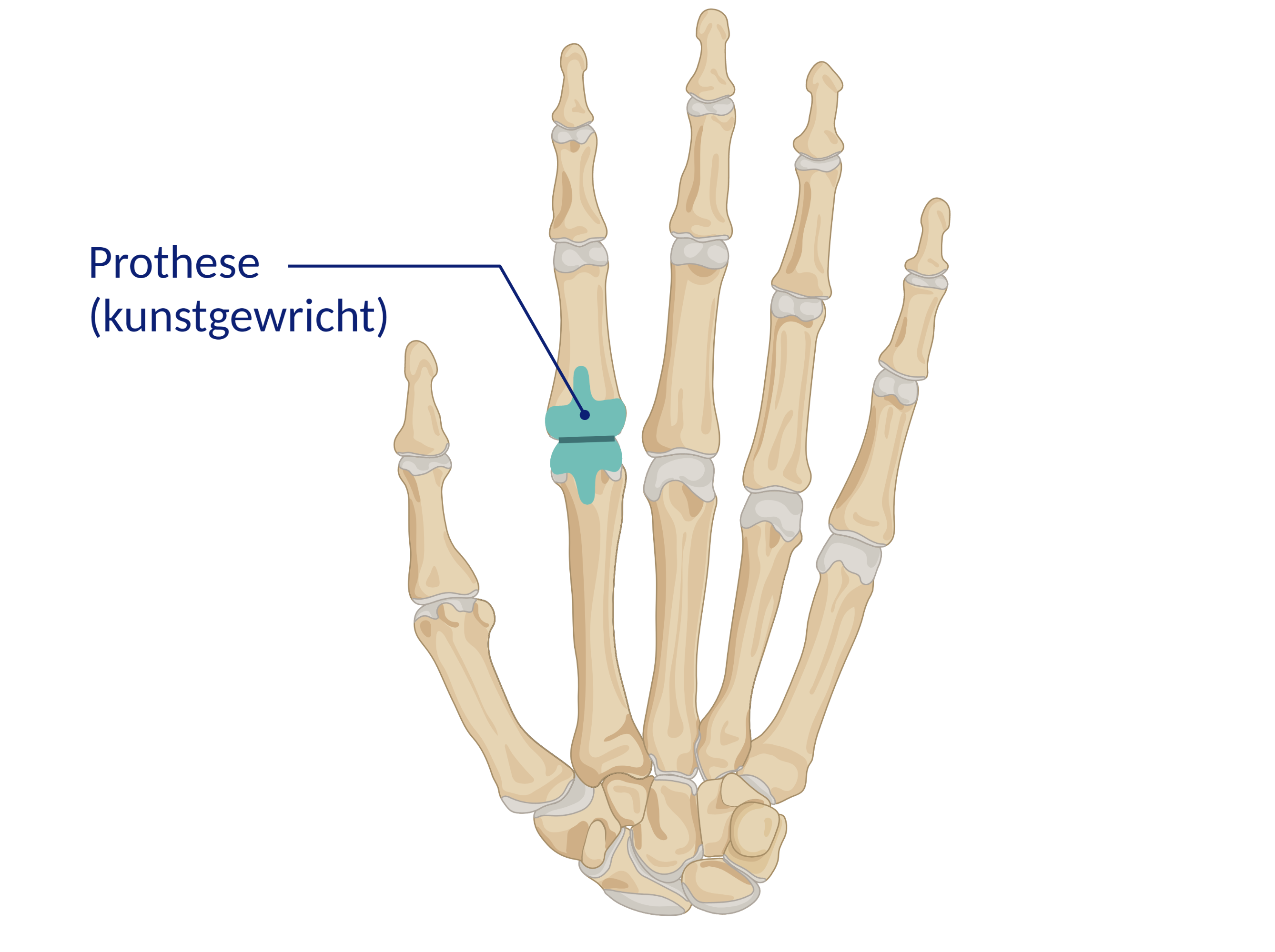 MCP-artrose - Patiëntenfolder - Erasmus MC