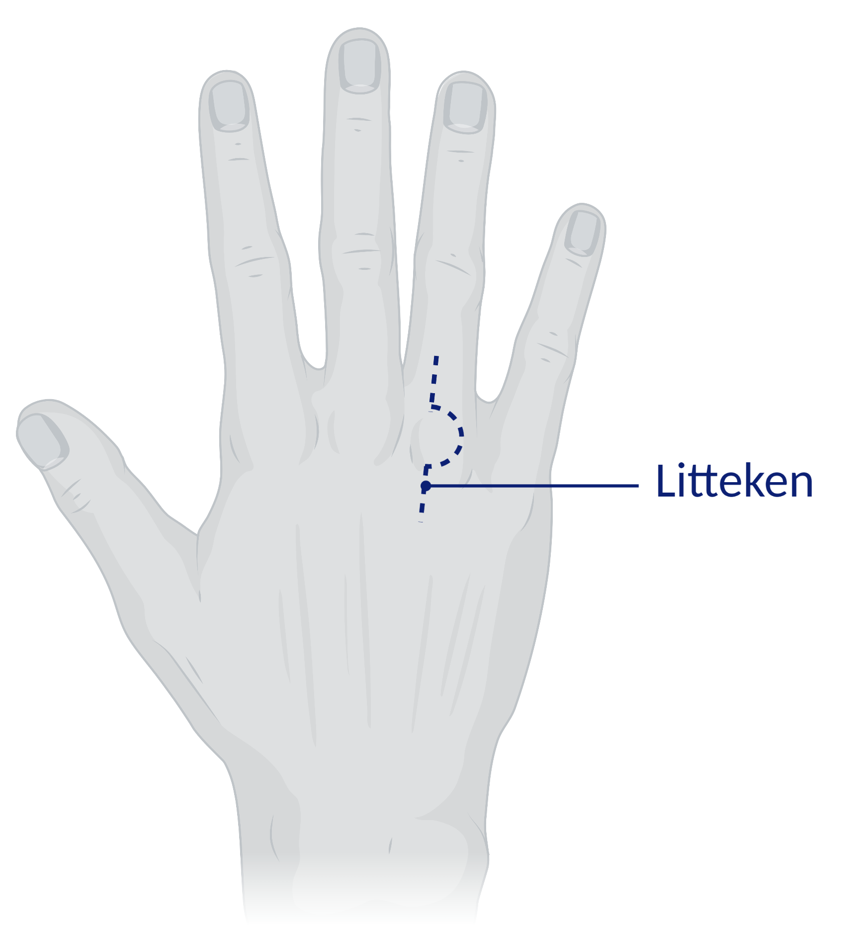 MCP-prothese - Patiëntenfolder - Erasmus MC