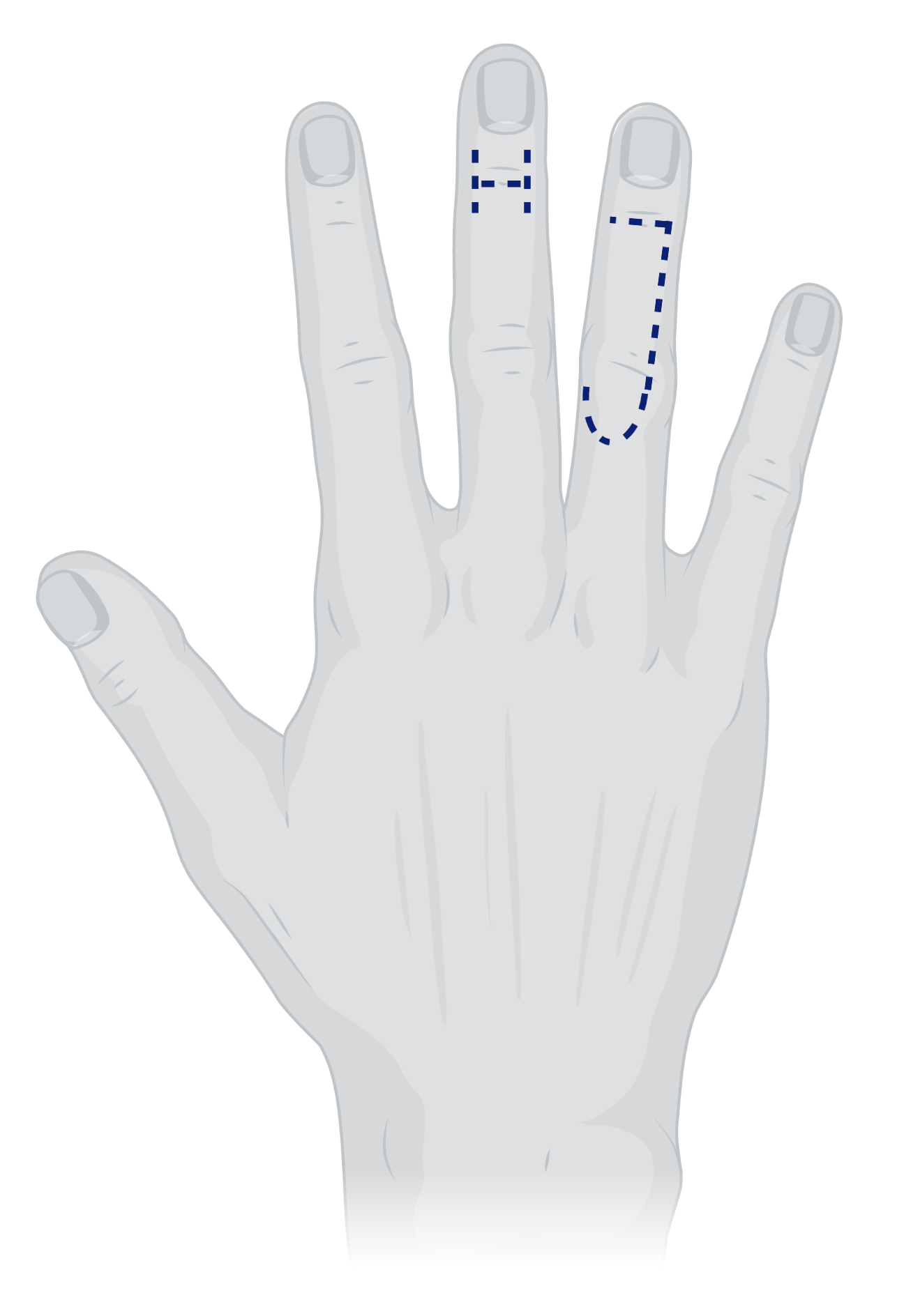 Verwijderen mucoidcyste op de vinger - Patiëntenfolder - Erasmus MC