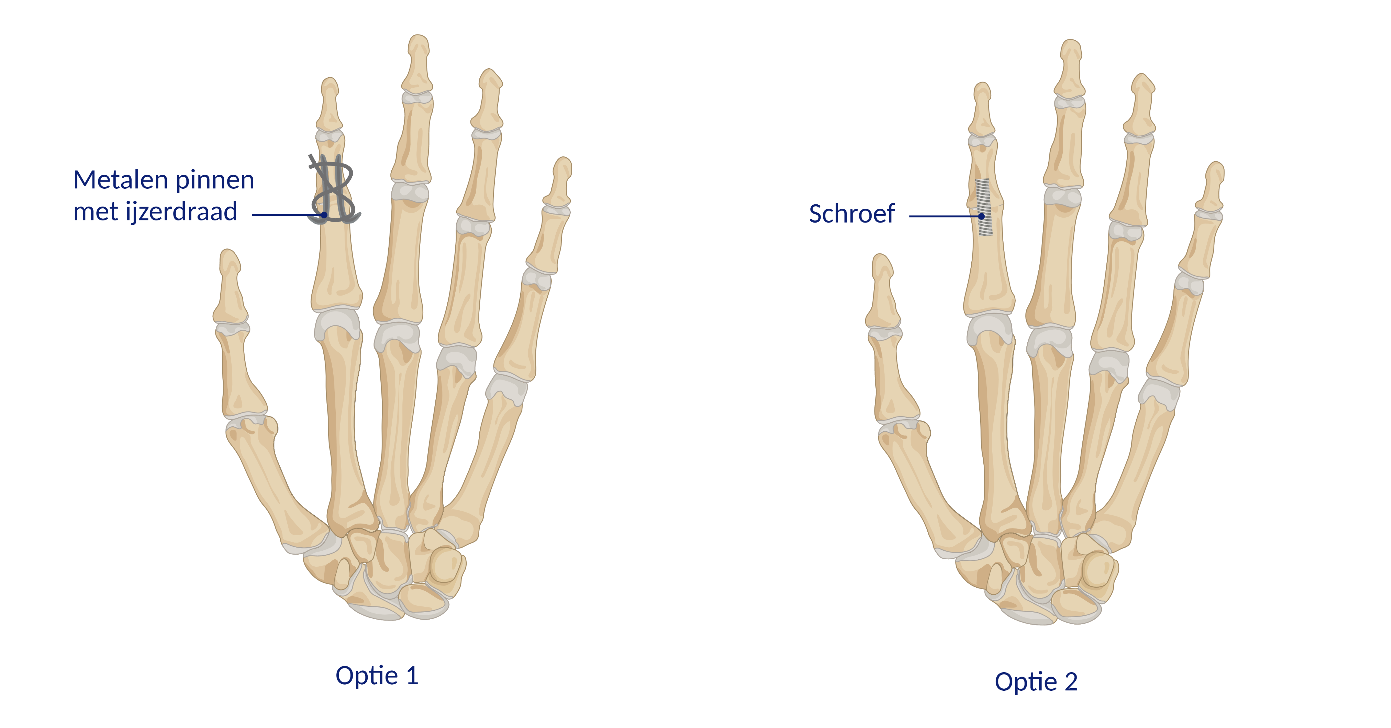 Vastzetten PIP-gewricht (arthrodese) - Patiëntenfolder - Erasmus MC