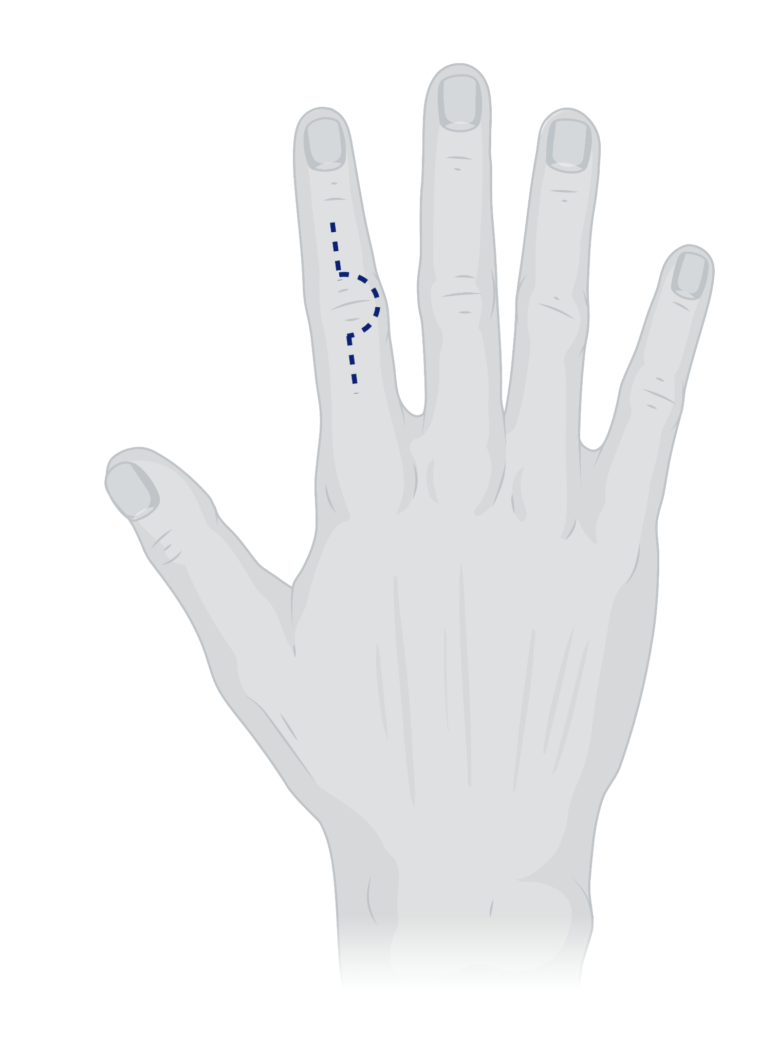 PIP-prothese - Patiëntenfolder - Erasmus MC