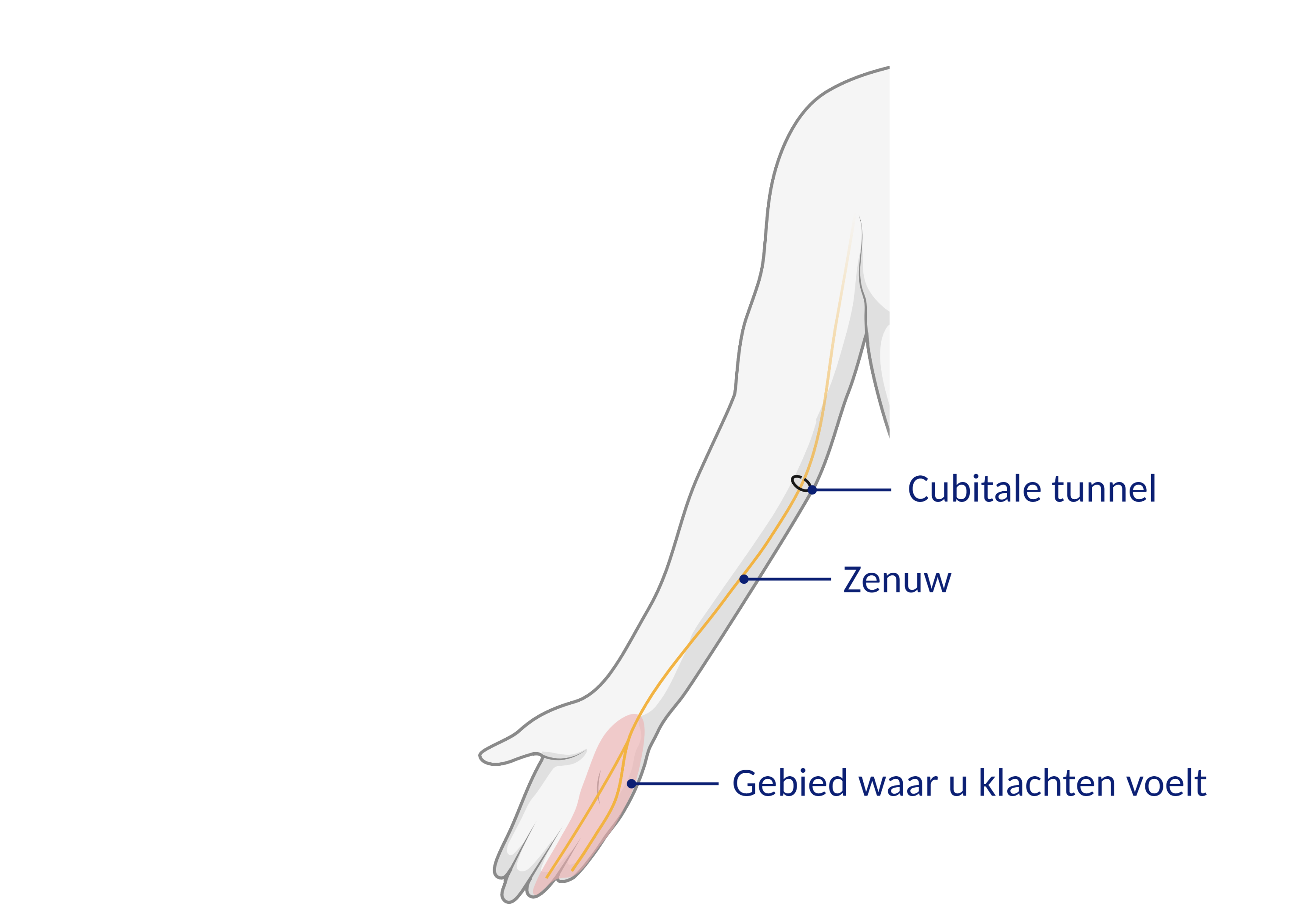 Cubitaal tunnel syndroom - Patiëntenfolder - Erasmus MC