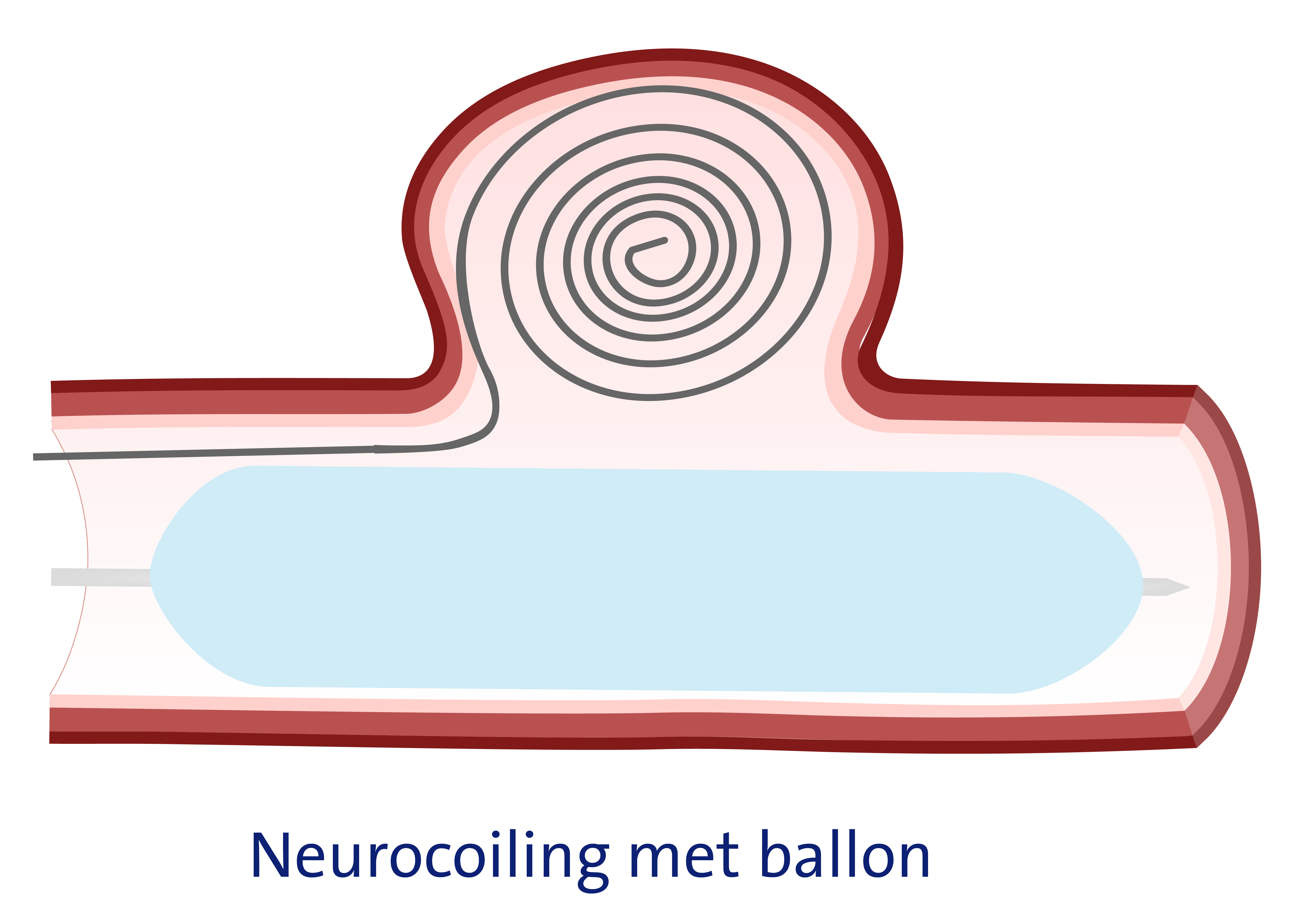 Neurocoiling - Patiëntenfolder - Erasmus MC