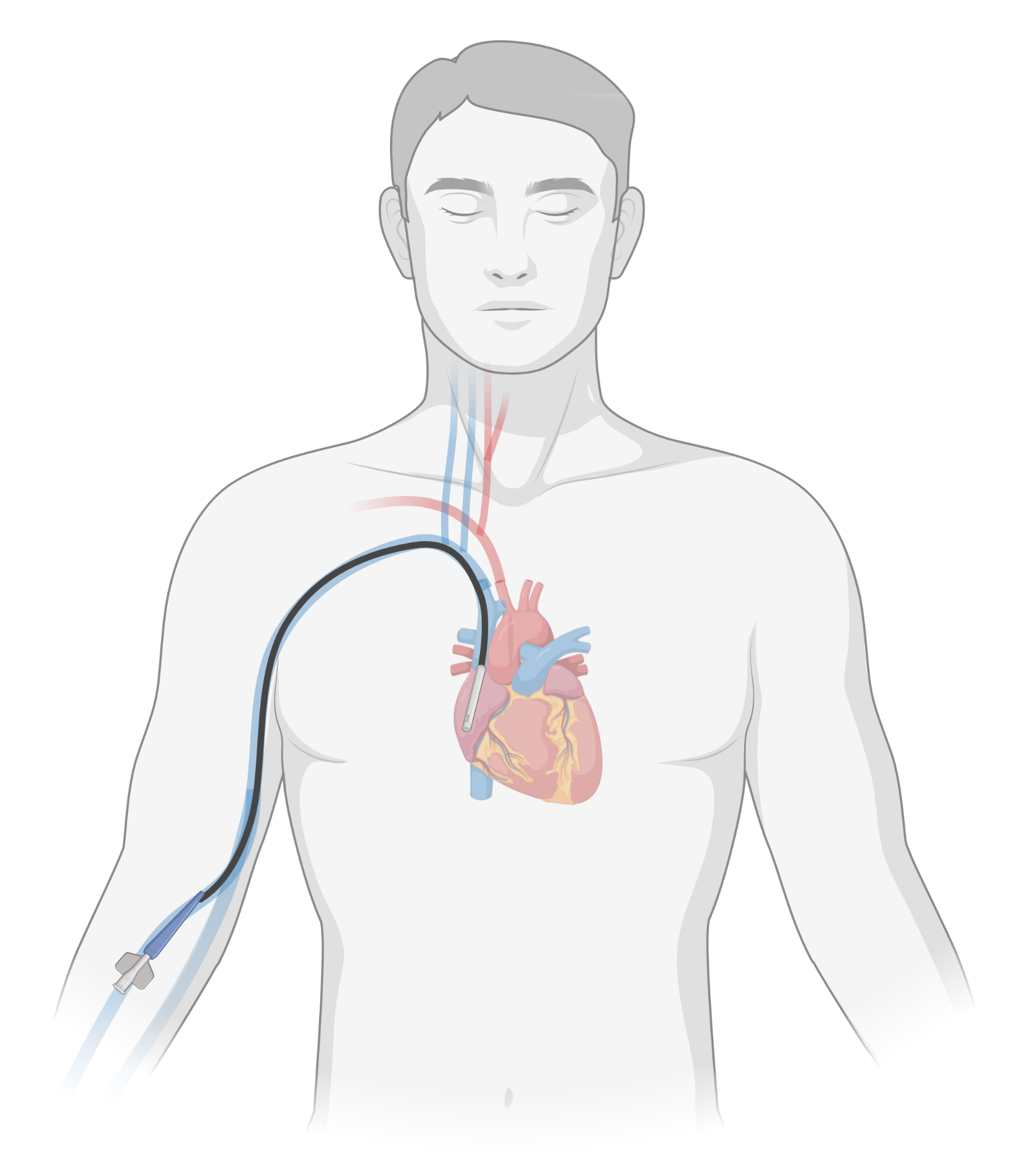 PICC-lijn plaatsing - Patiëntenfolder - Erasmus MC