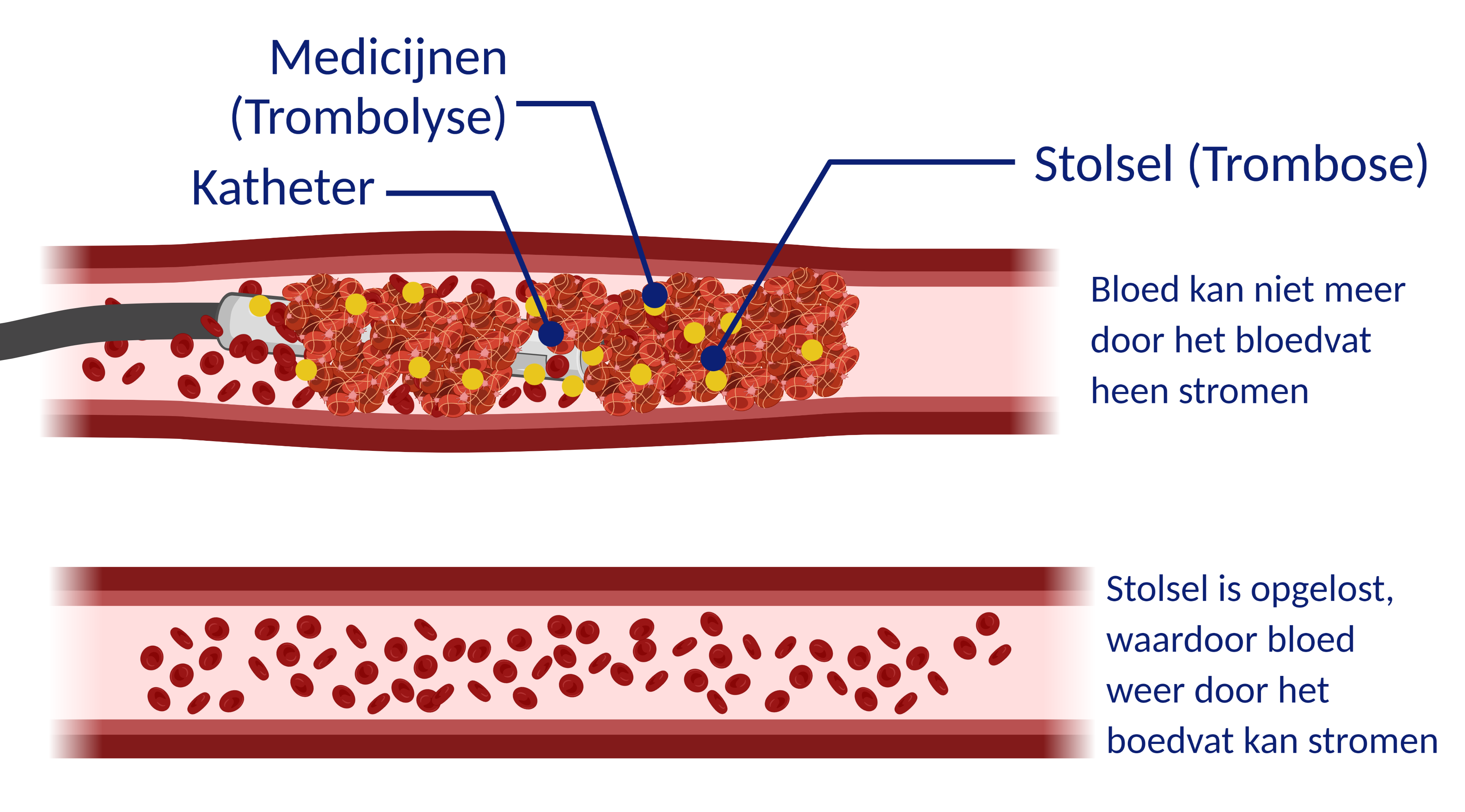 Trombolysebehandeling - Patiëntenfolder - Erasmus MC