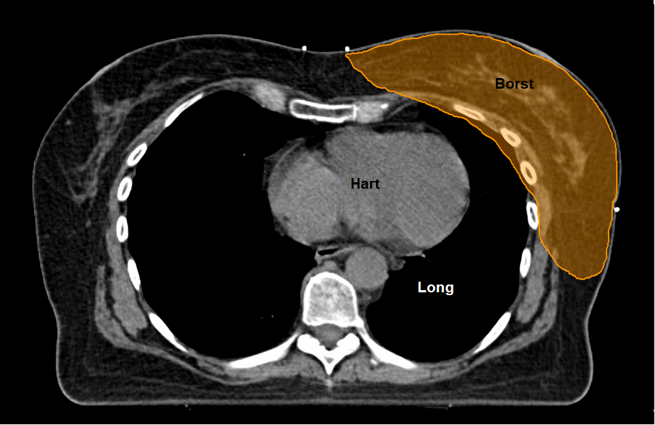 Ademen met breath-hold techniek bij bestraling van linkerborst of ...