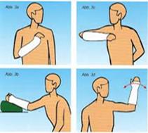 Gipsverband arm - Patiëntenfolder - Erasmus MC