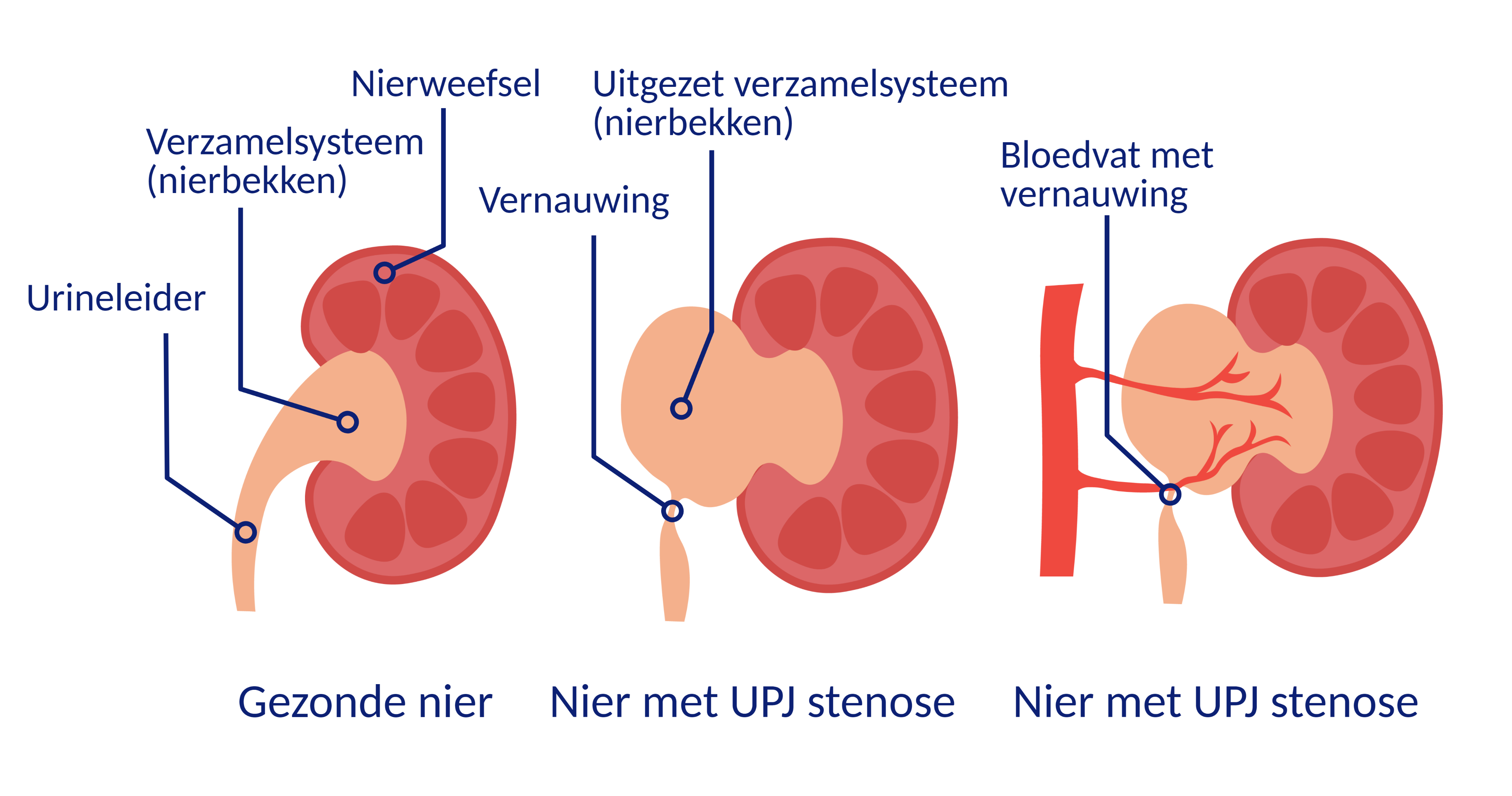 UPJ stenose - Patiëntenfolder - Erasmus MC