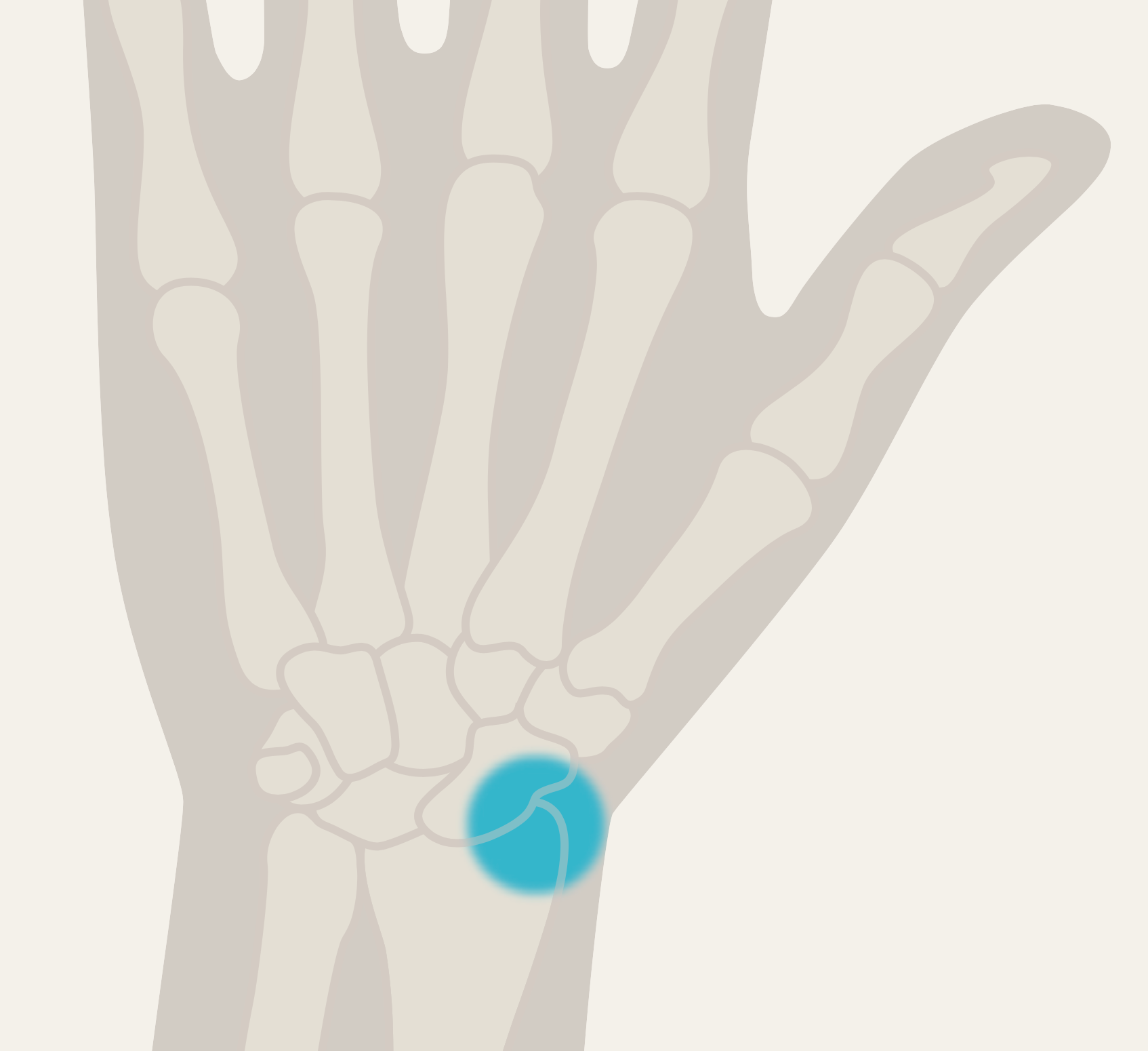 Ganglion in de pols - Patiëntenfolder - Erasmus MC
