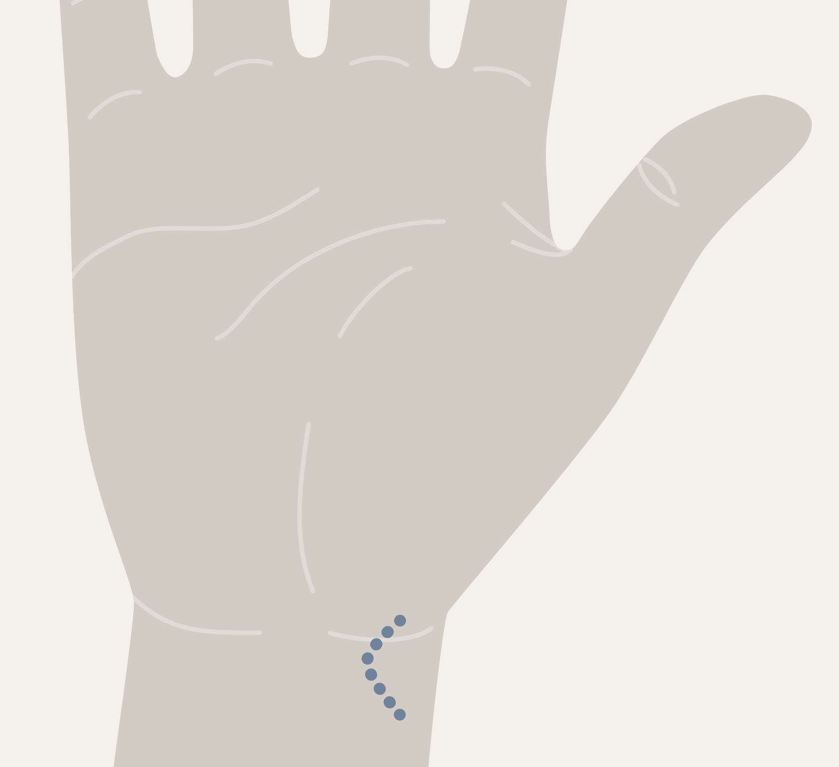 Ganglion in de pols - Patiëntenfolder - Erasmus MC