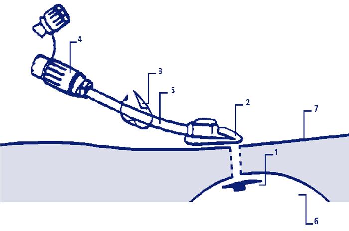 PEG-katheter - Patiëntenfolder - Erasmus MC