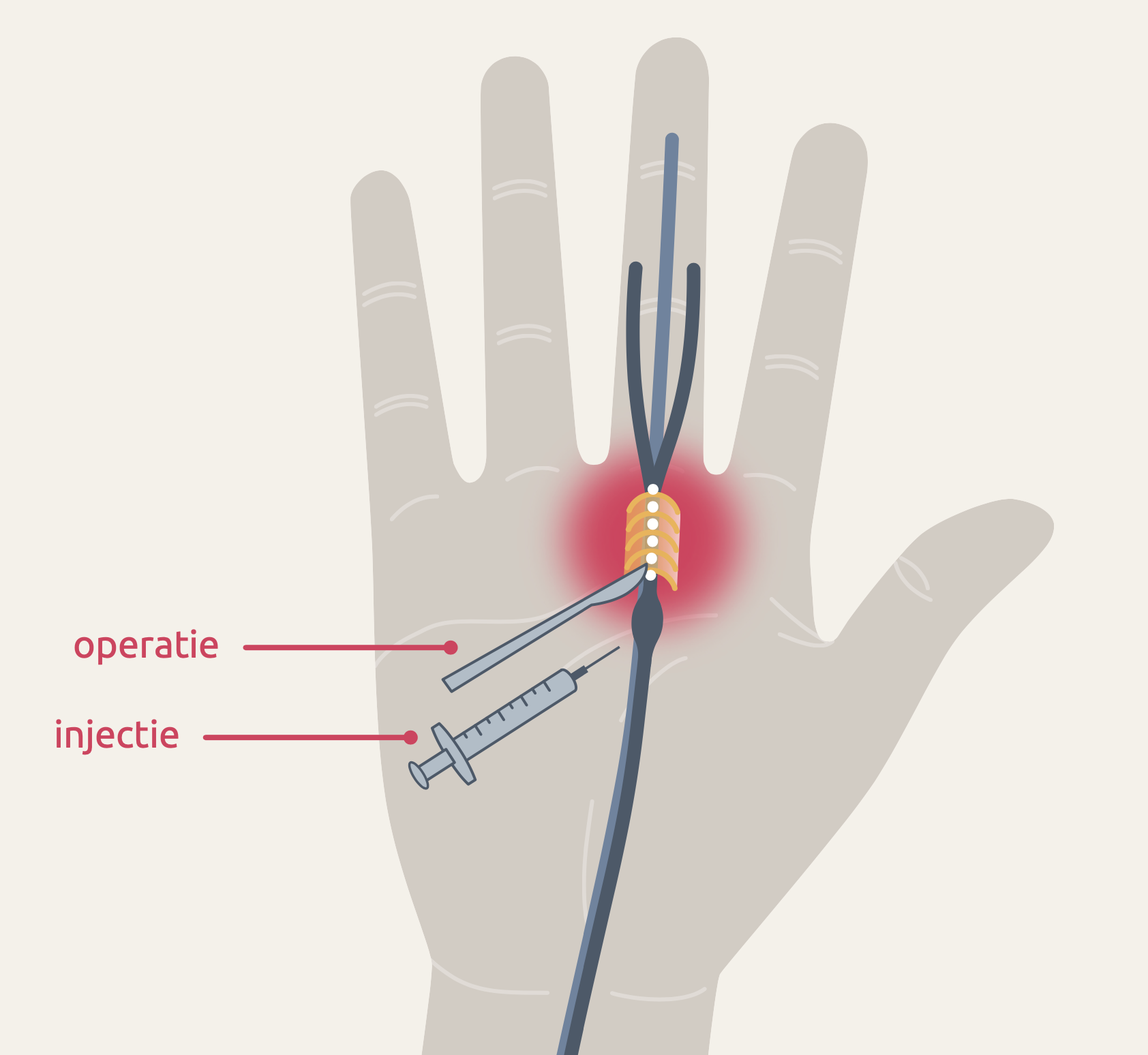 Trigger finger - Patiëntenfolder - Erasmus MC